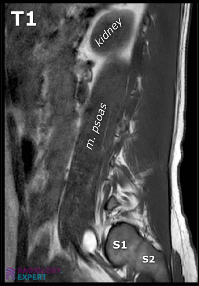 Mri Lumbar Spine 1726